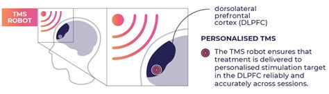 Personalised Transcranial Magnetic Stimulation Tms Queensland Neurostimulation Centre