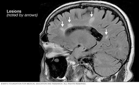 Multiple Sclerosis Disease Reference Guide