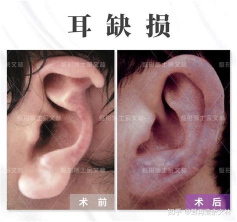 说先天性耳畸形太多了今天讲后天耳畸形 知乎