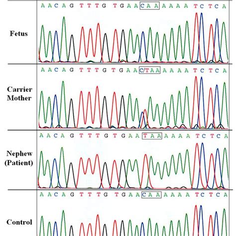 Nucleotide Sequence Of Cybb From A723 To A747 In The Fetus The Carrier