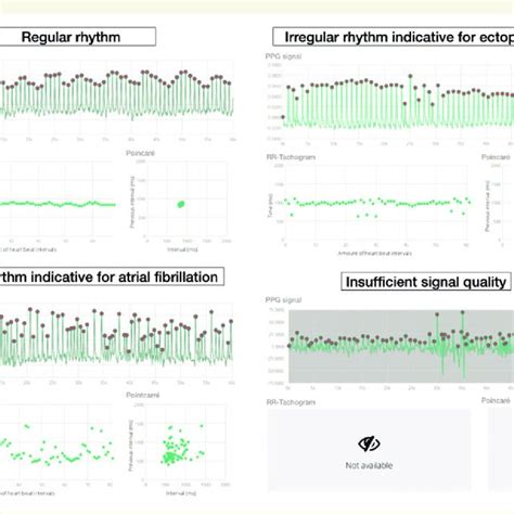 Examples of raw PPG traces and their tachogram and Poincaré plot Download Scientific Diagram