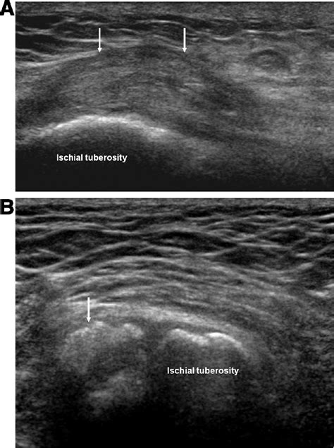 Figure 6 From Sonographic Examination Of The Buttock Semantic Scholar