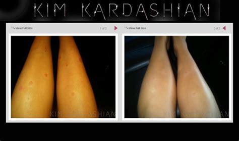 Kim Kardashian Reveals Her Godsend For Psoriasis