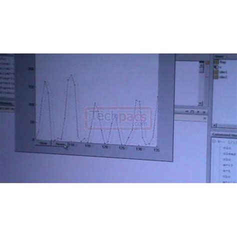 Matlab Based Real Time Wireless Electrocardiogram Ecg Monitoring System Using Microcontroller