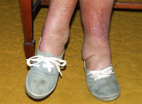 Leg Edema And Liver Disease At Connie Mays Blog