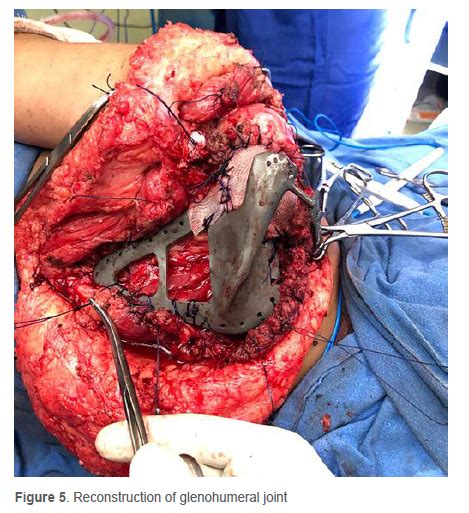 3d Printing In Osteosarcoma Of The Scapula A Unique Case