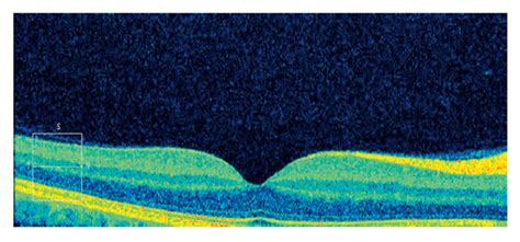 Fileout Of Range Errorpng Eyewiki