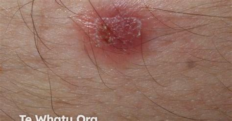 Secondary Syphilis Image