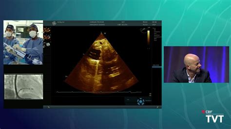 Live Case 28 Ice Only Mitral Teer With Pascal Montefiore Medical Center Bronx Ny
