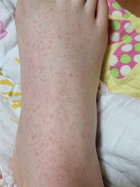 씻고나면 피부가 빨갛게 변해요 지식in