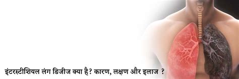 इंटरस्टीशियल लंग डिजीज Ild मध्य फेफड़ों के रोग लक्षण और उपचार Interstitial Lung Disease