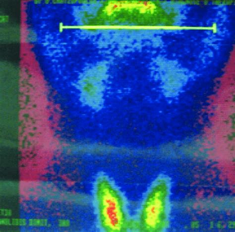 The Scintiscan Of The Area With A Tc 99m Showing No Evidence Of The