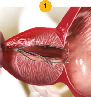 ITind Olympus America Medical