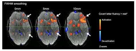 Consensus Recommendations For Clinical Functional Mri Applied To Language Mapping Published In