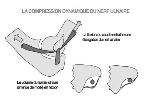 Compression du nerf ulnaire au coude tunnel ulnaire IMCEP ChirurgIe Main Coude Épaule