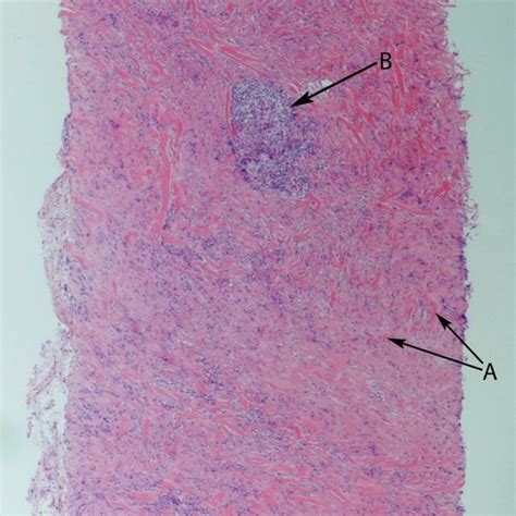 Thyroid Gland Core Biopsy Specimen Shows Dense Fibrosis With Download Scientific Diagram