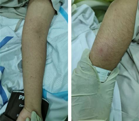 Newly Seen Generalized Petechial Rash Day Following Admission Download Scientific Diagram