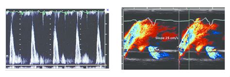 Mitral Inflow Doppler Velocity Figure 2 Color M Mode Flow Propagation Download Scientific