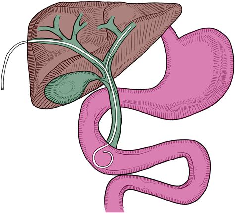Management Of Acute Cholangitis And Choledocholithiasis Surgical Clinics