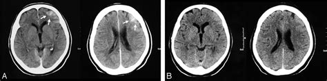 Focal Increased Cortical Density In Immediate Postembolization Ct Scans