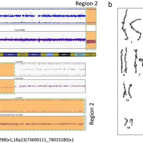 Snp Microarray And Karyotype Analyses Identified A Ring Chromosome 18 Download Scientific