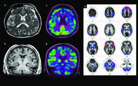 Frontotemporal Dementia Ftd Magnetic Resonance Images Bilateral Download Scientific Diagram