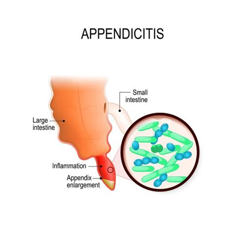 Appendicitis Symptoms In Women STD GOV Blog