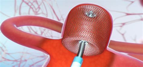 MICROVENTION DGM VASCULAR