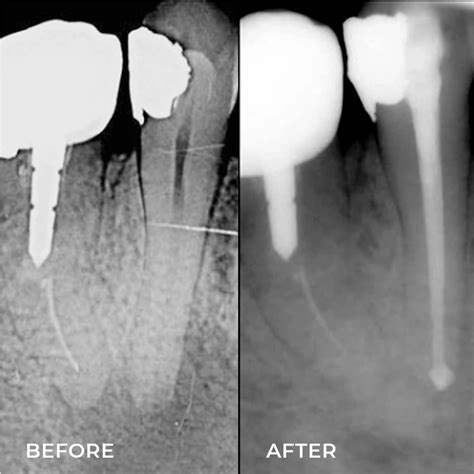 Before And After Root Canal Treatment Aburas Dental Centre