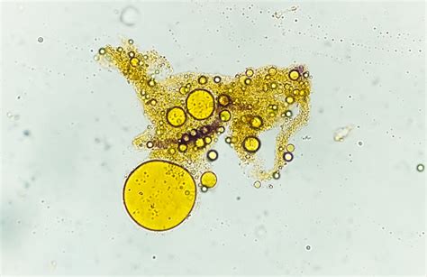 Microscopic View Of Stool Analysis Showing Neutral Fat Fecal Fat