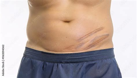 Close Up Of A C Section Surgical Scar On The Lower Abdomen Showing