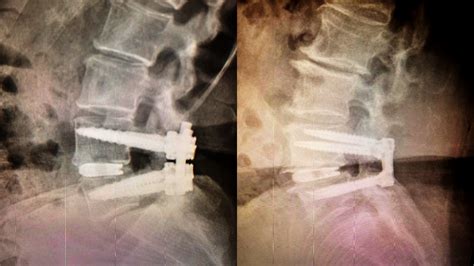 PressON Is Smaller Faster Stronger Nexus Spine