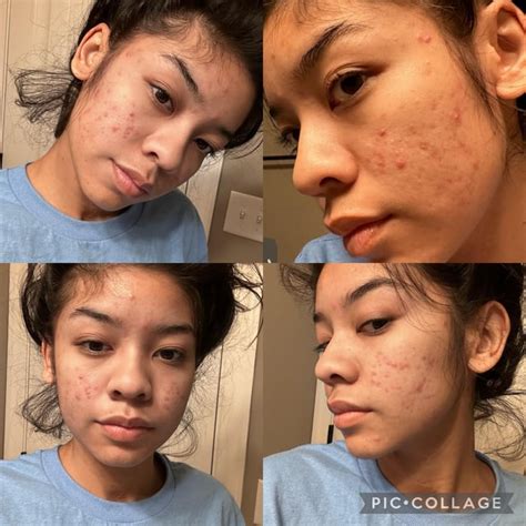 [acne] Does Acne Come Back After Doxycycline R Skincareaddiction