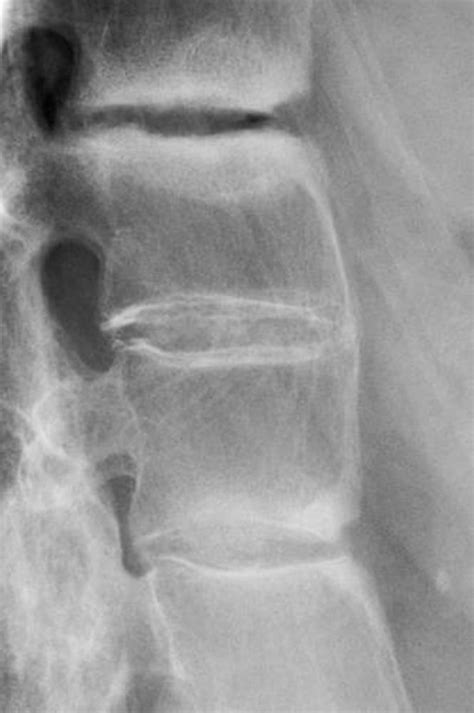 Анкілозуючий спондиліт Захворювання скелетно мязової та сполучної тканини Msd Manual
