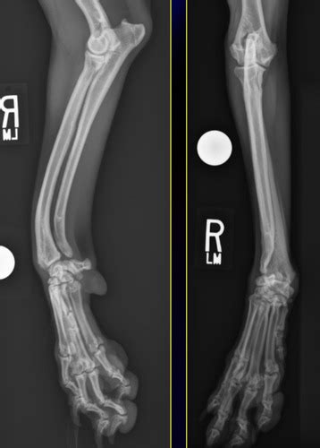 Lecture 31 Limb Deformity Flashcards Quizlet