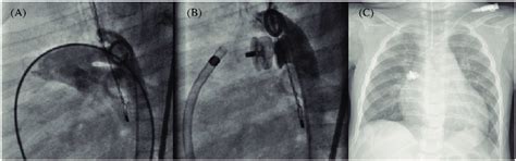 Early Embolization Of A 10 Mm Avp Ii After Pda Closure Multiple Download Scientific Diagram