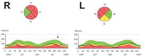 Circular Oct Scans At 34 Mm Diameter Through The Center Of The Optic