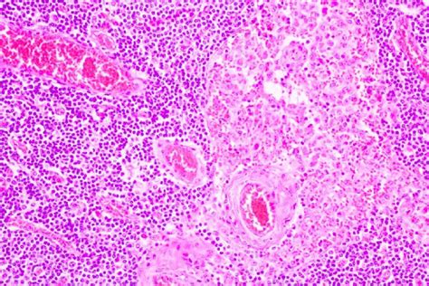 Royal College Of Pathologists Rcpath On Linkedin Rcpathds Breast