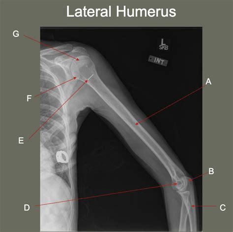 Humerus Lateral Diagram Quizlet