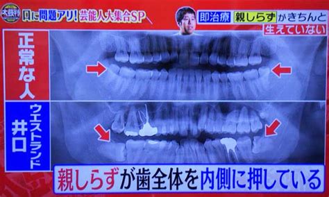 ウエストランドの井口浩之さんの二重歯列を評論（歯列矯正スタート） 僕の審美歯科ガイド｜前歯の差し歯治療で後悔しないための情報源