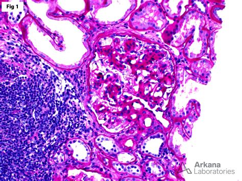 Fsgs Tip Lesion Teaching Points Arkana Laboratories