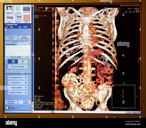 Aorta Artery Rib Cage Cat Computerized Axial Tomography Scan Radiology Medical Imaging For