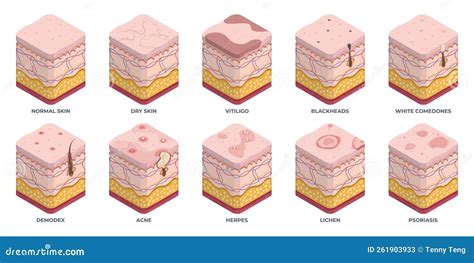 Isometric Human Skin Types 3d Epidermis Layers Dermatology Normal Oily And Dry Epidermis