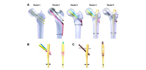 Five Different Implants After Assembly Of The Finite Element Model A Download Scientific