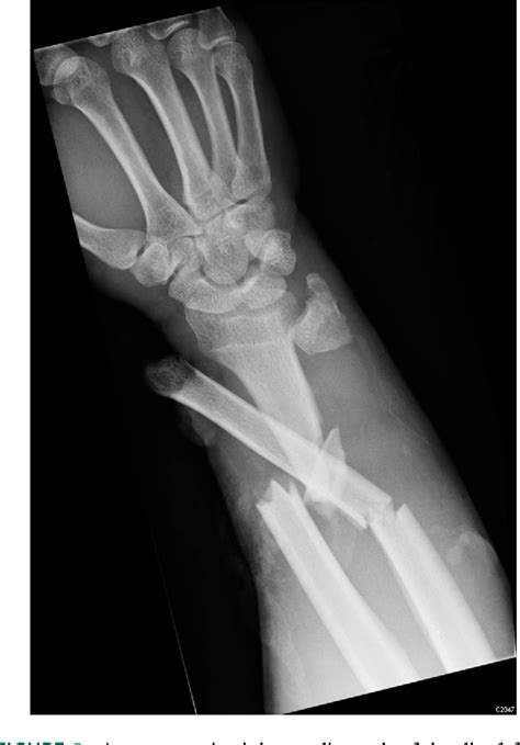 Compound Fractures X Ray