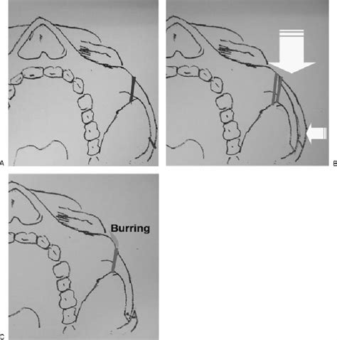 A Method Of Mobilizing The Zygomatic Complex Could Be Subdivided