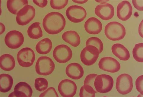 Hematology Hematocrit Flashcards Quizlet