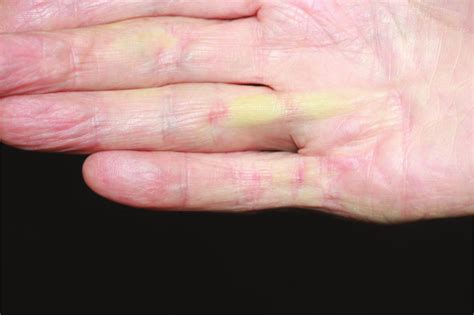 The Appearance Of Full Extension With A Residual 30 O Pipj