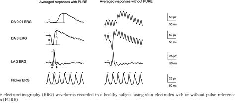 Figure 1 From The Effect Of Age On Full Field Electroretinograms Recorded With Skin Electrodes