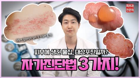 대상포진💥 치료하는데 골든타임⏳이 있다고 😱 물집이 생겼을 때 자가진단방법 3가지 👐[송도휴먼피부과] Youtube